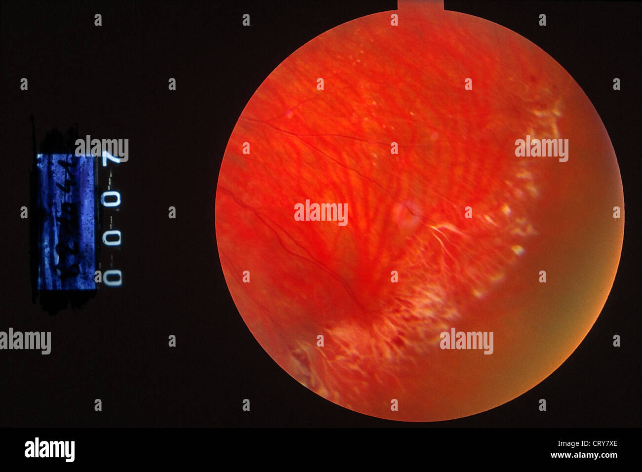 Snail Track Degeneration