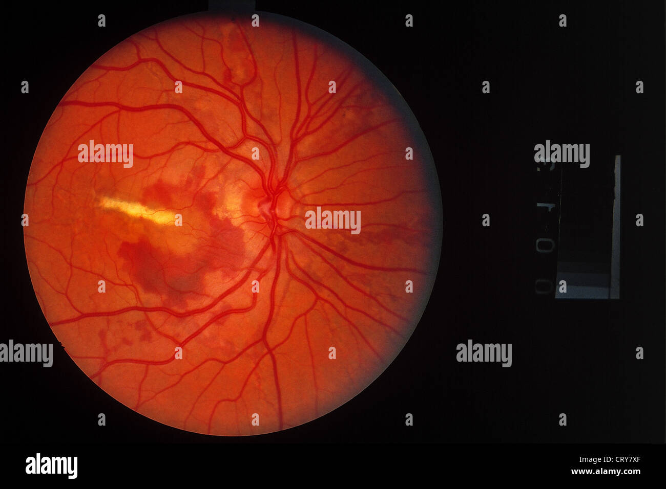 Neo angiogenesis hi-res stock photography and images - Alamy