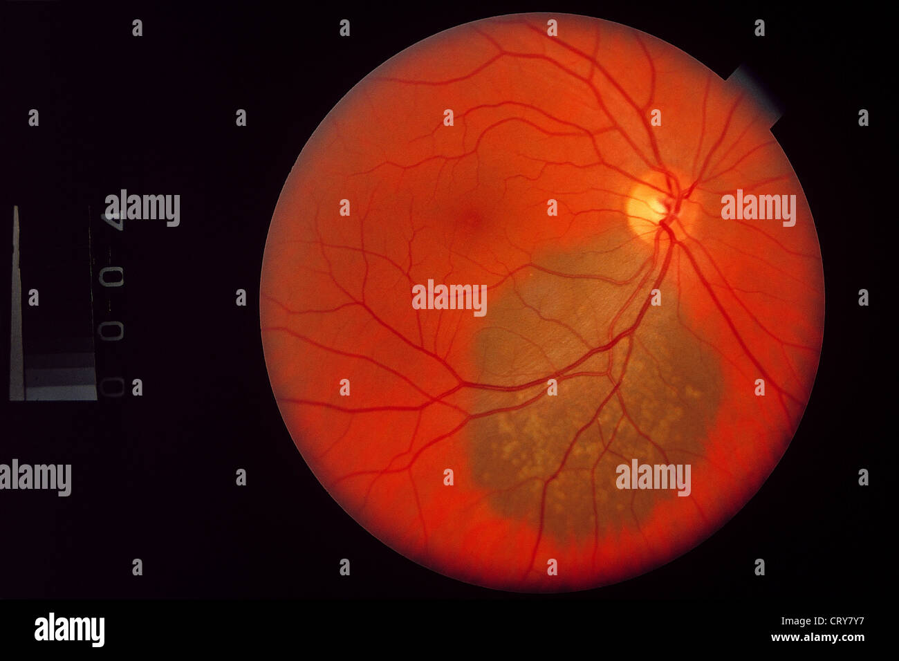 Nevus naevocytic hi-res stock photography and images - Alamy
