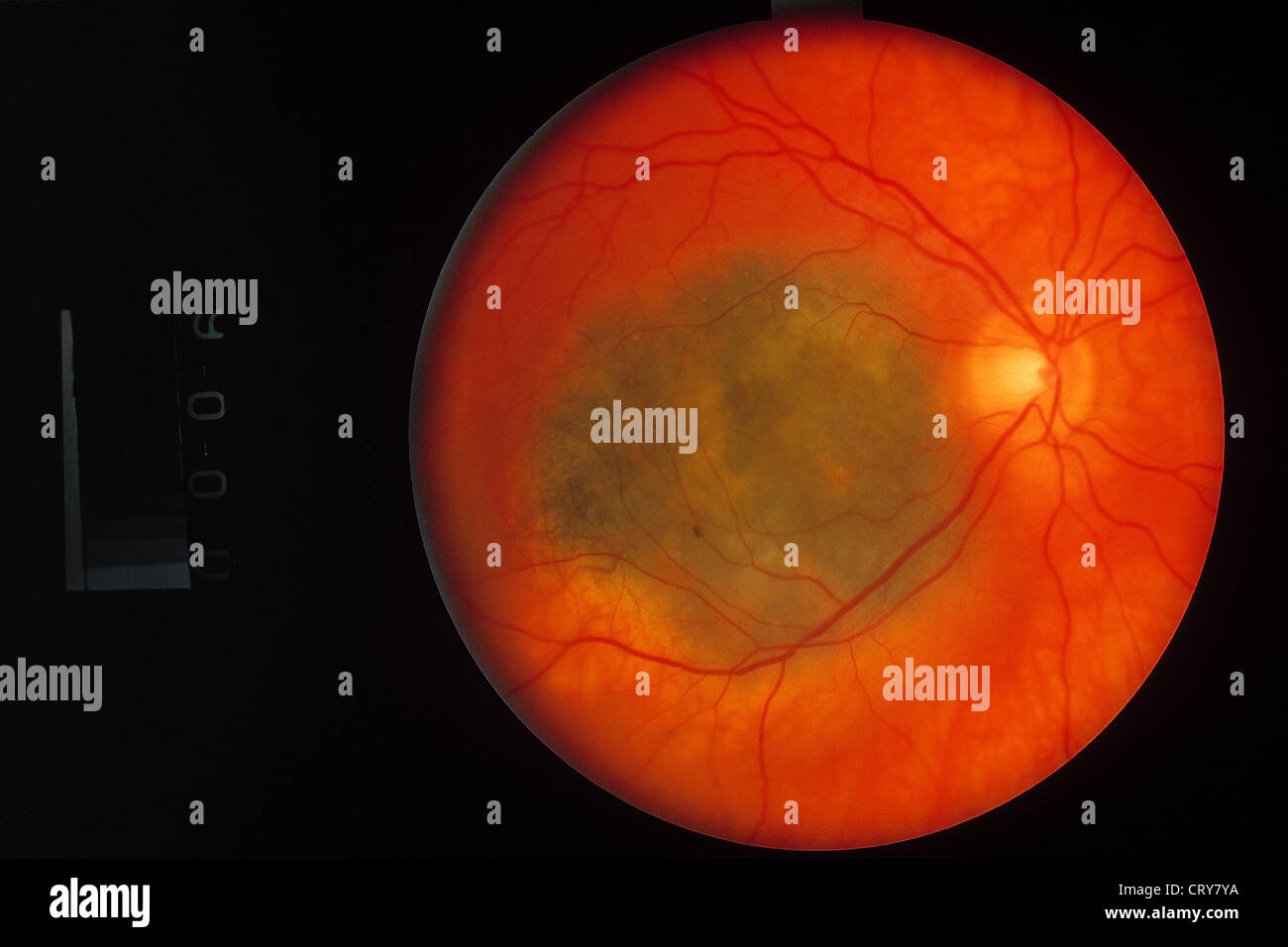 Retinal melanoma hi-res stock photography and images - Alamy
