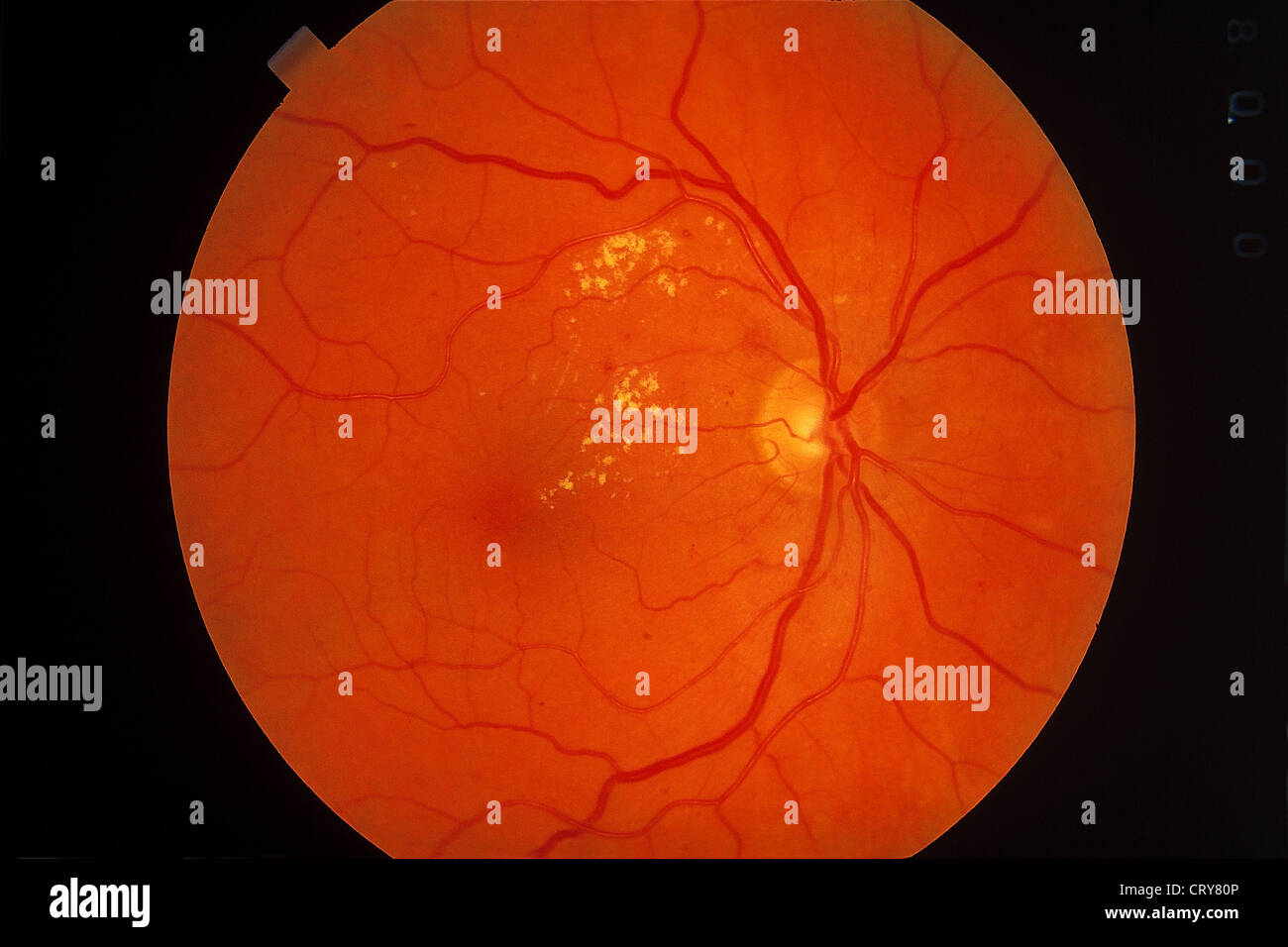 Diabetes eye fundus camera hi-res stock photography and images - Alamy