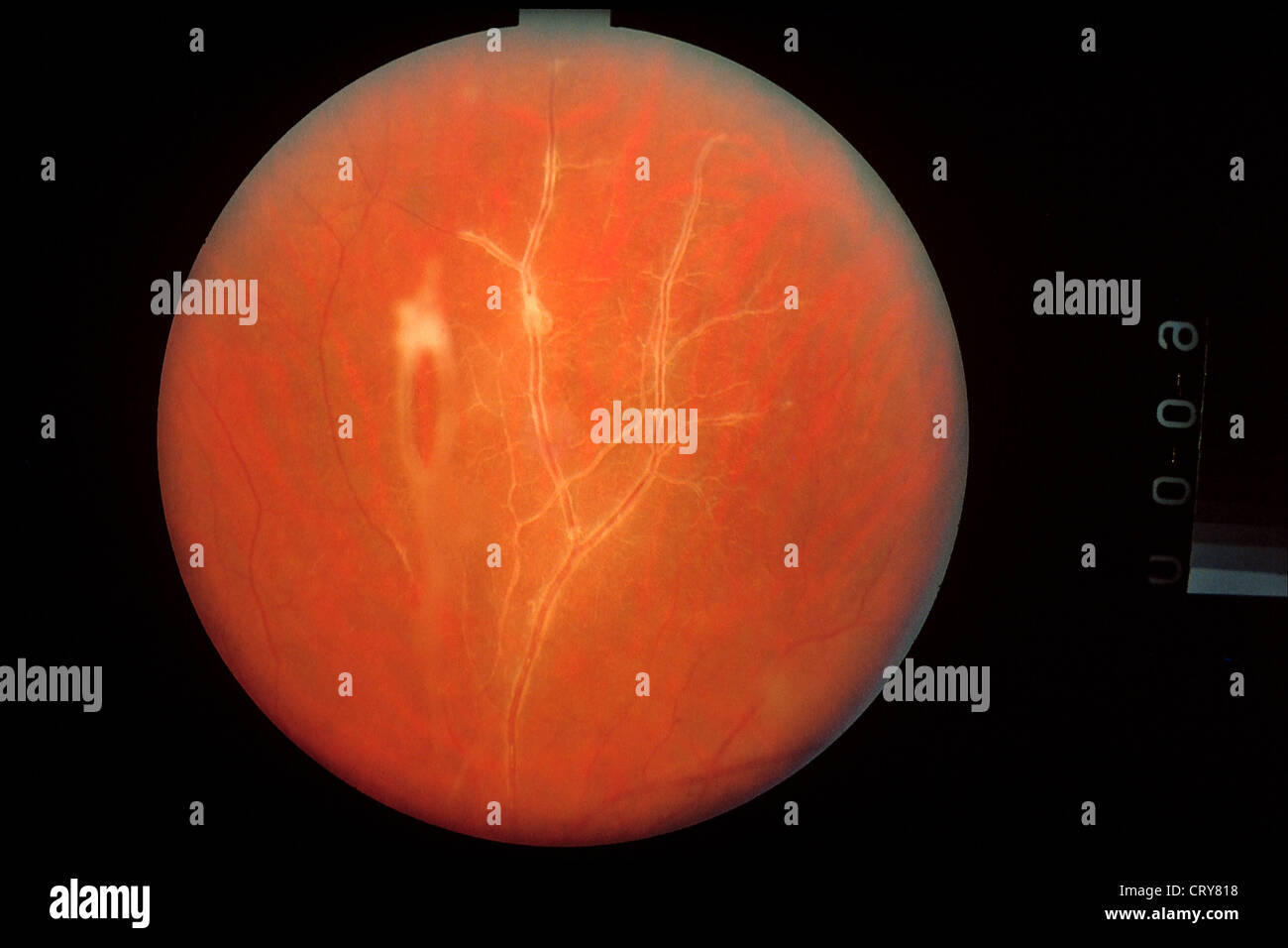 Retinal vasculitis hi-res stock photography and images - Alamy