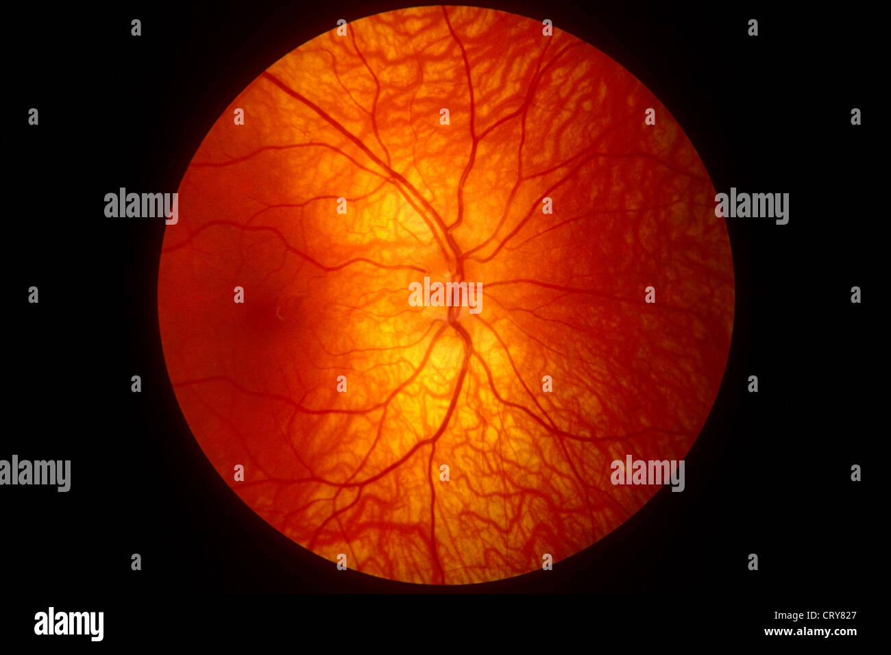 FUNDUS OCULI RESULT Stock Photo - Alamy