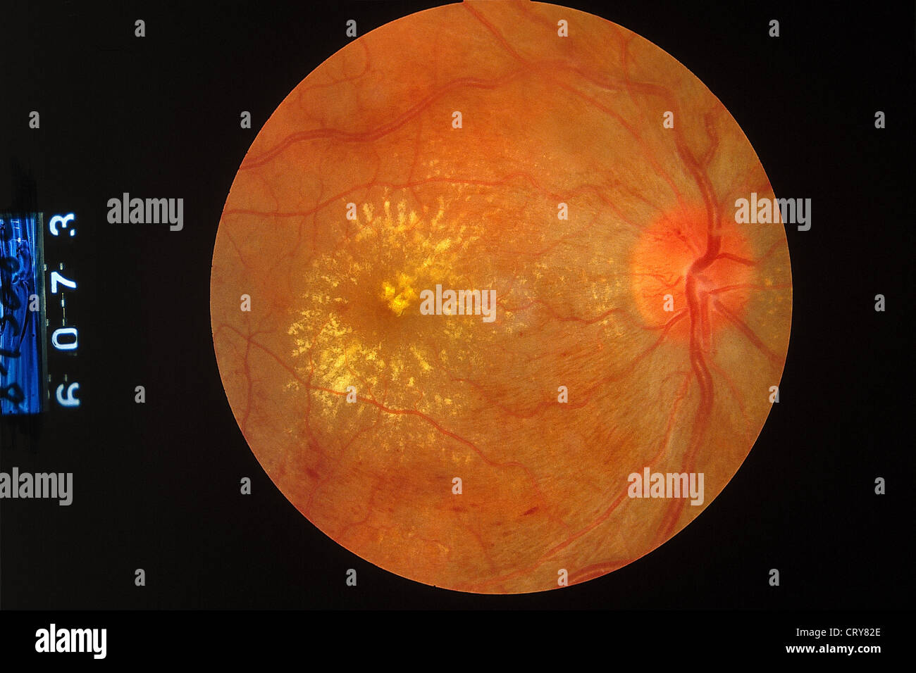 Diabetes eye fundus camera hi-res stock photography and images - Alamy