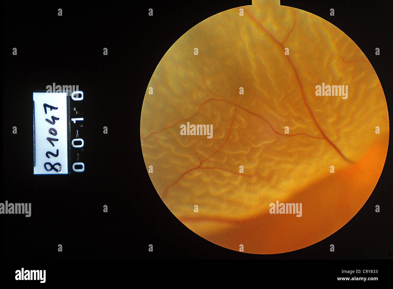 Ophthalmoscopy of detached retina hi-res stock photography and images ...