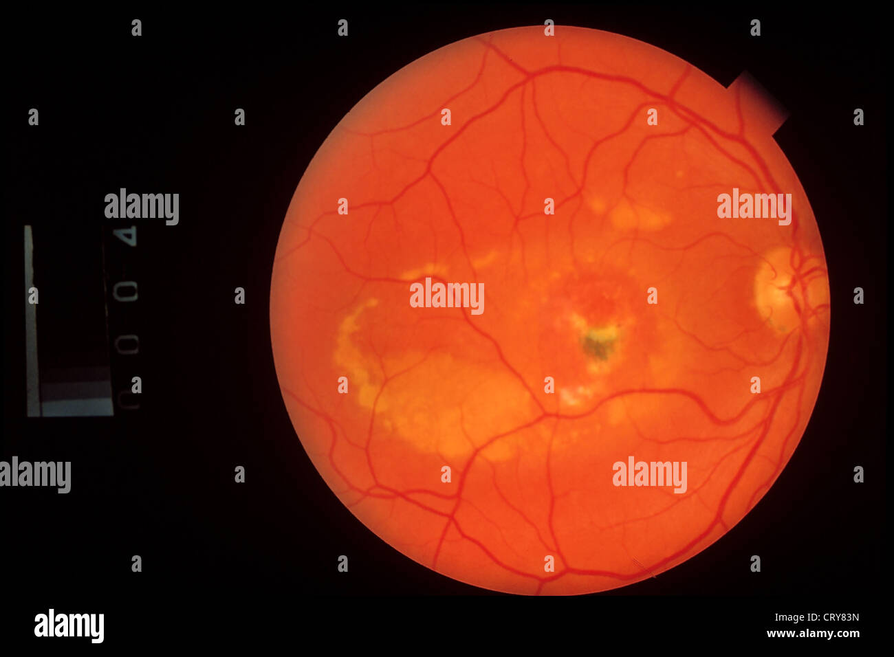 Degenerative eye diseases hi-res stock photography and images - Alamy