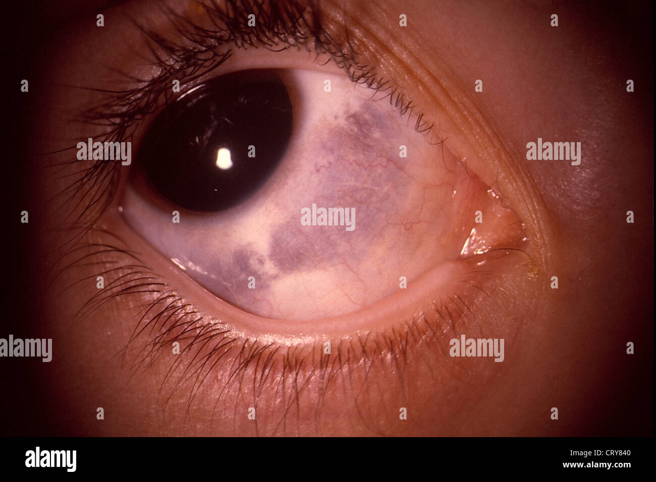 Optic atrophy hi-res stock photography and images - Alamy