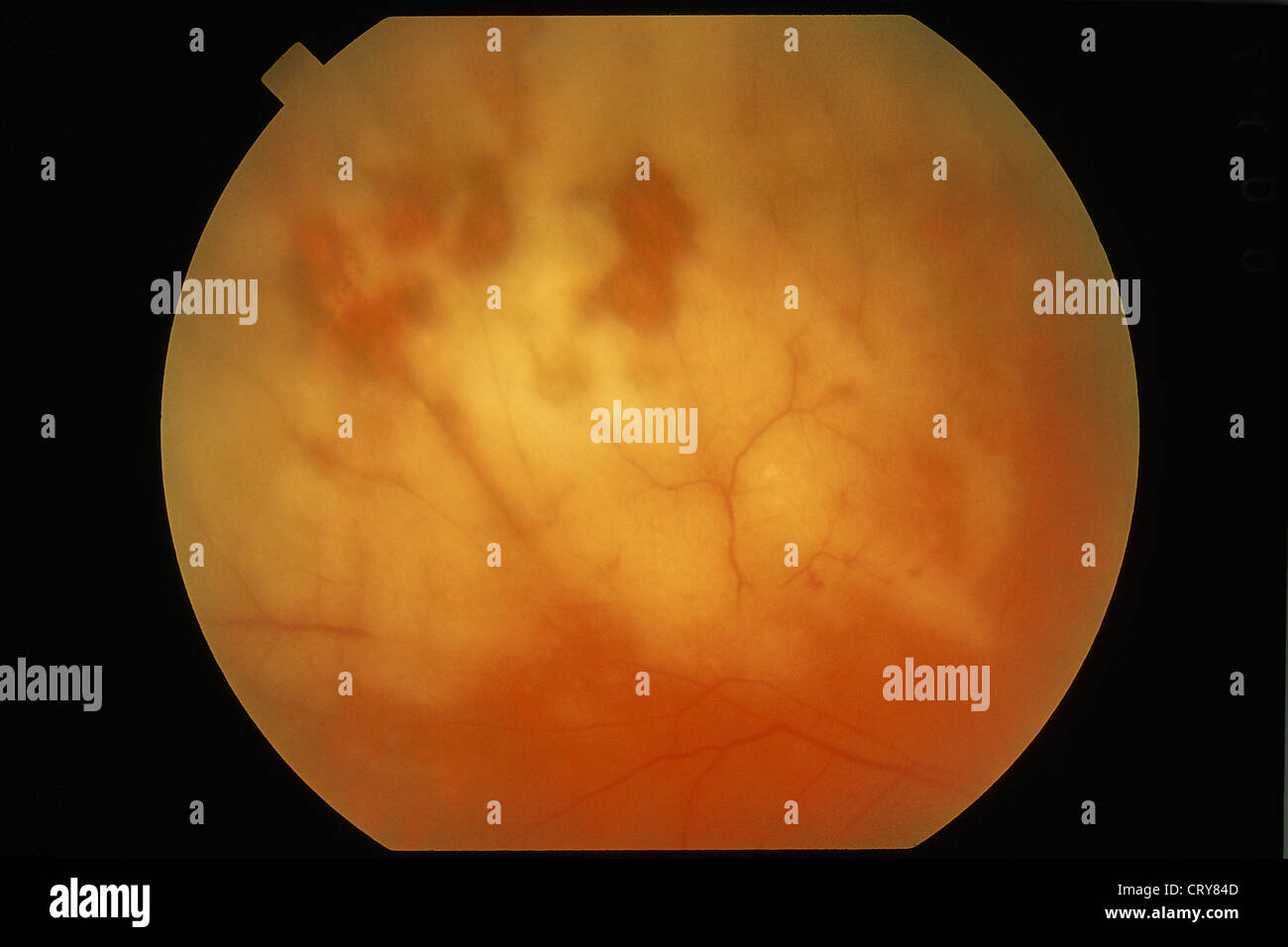 Cytomegalovirus Retinitis Hiv