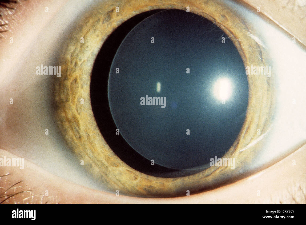 Dislocation lens hi-res stock photography and images - Alamy