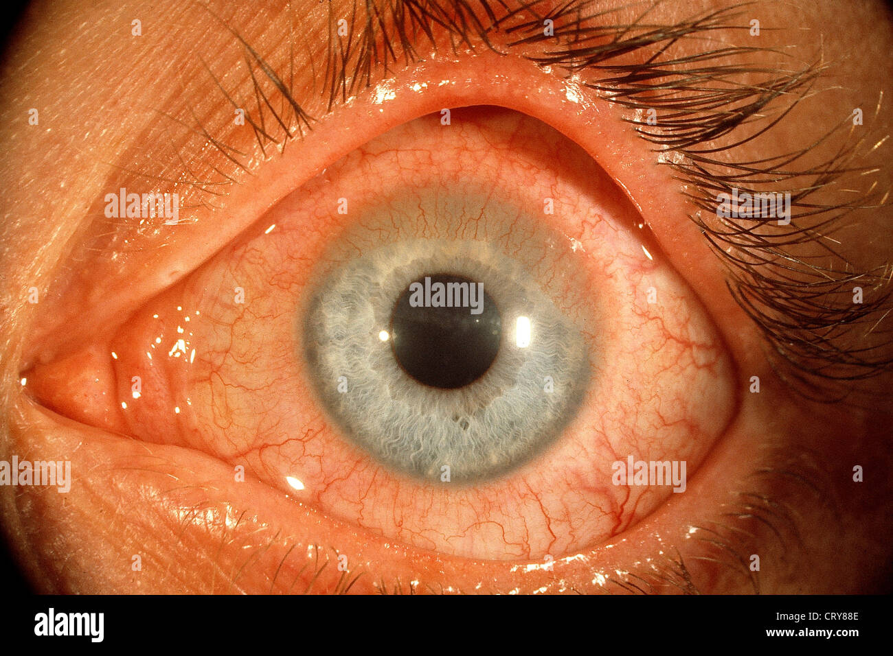 Trachomas hi-res stock photography and images - Alamy