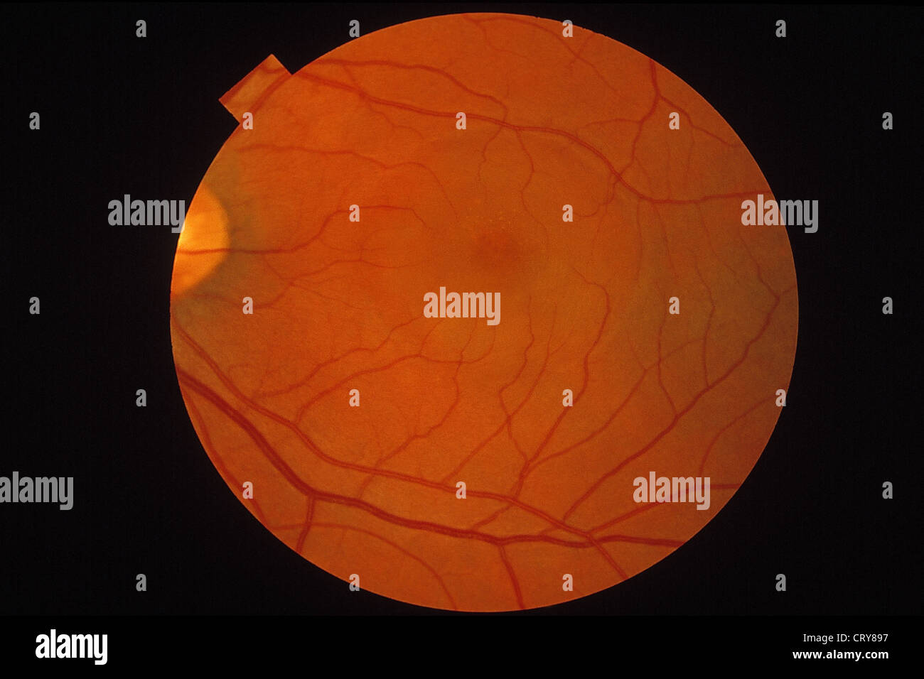 SEROUS CENTRAL CHOROIDITIS Stock Photo - Alamy
