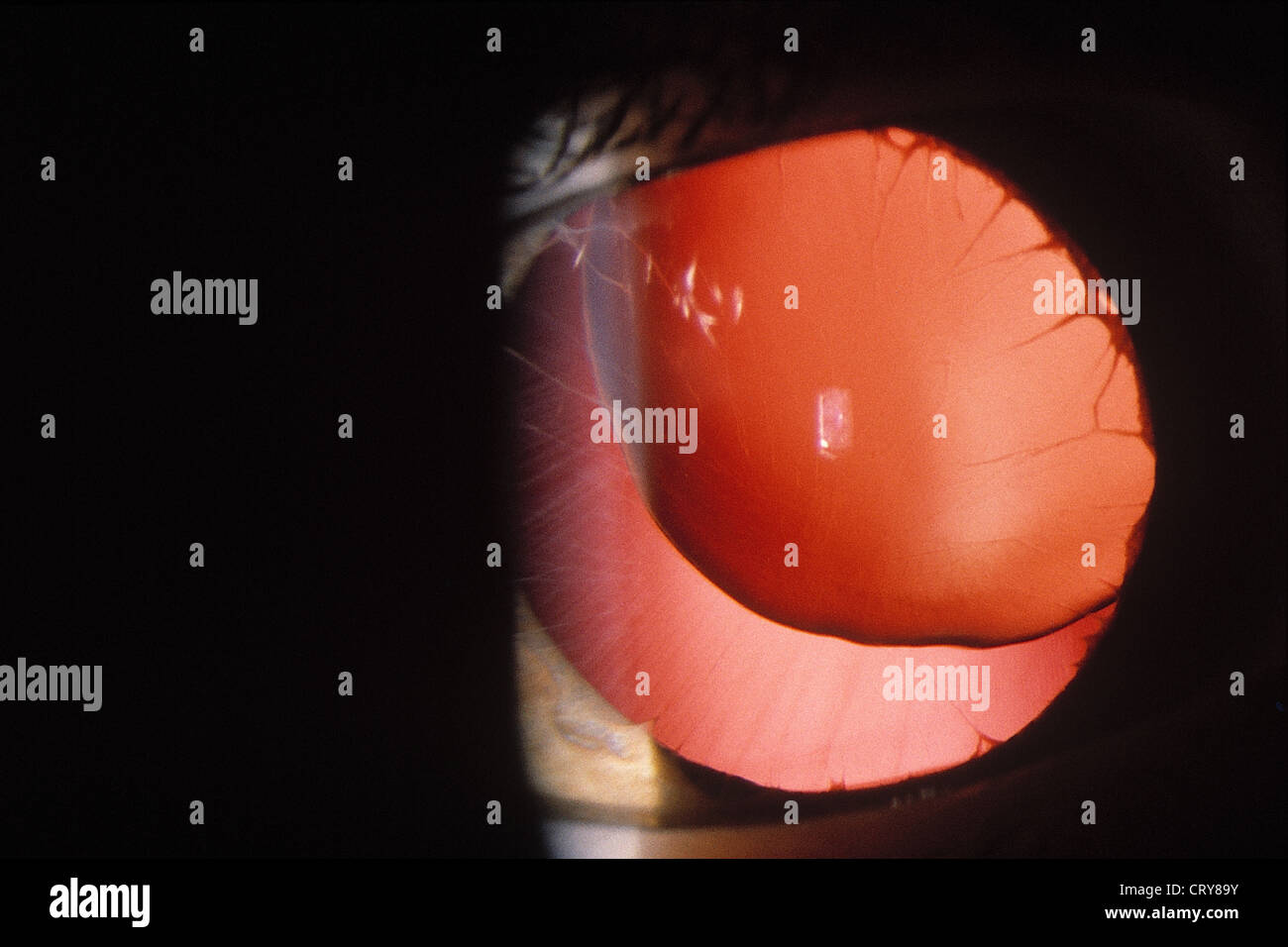 DISLOCATION OF THE LENS Stock Photo - Alamy