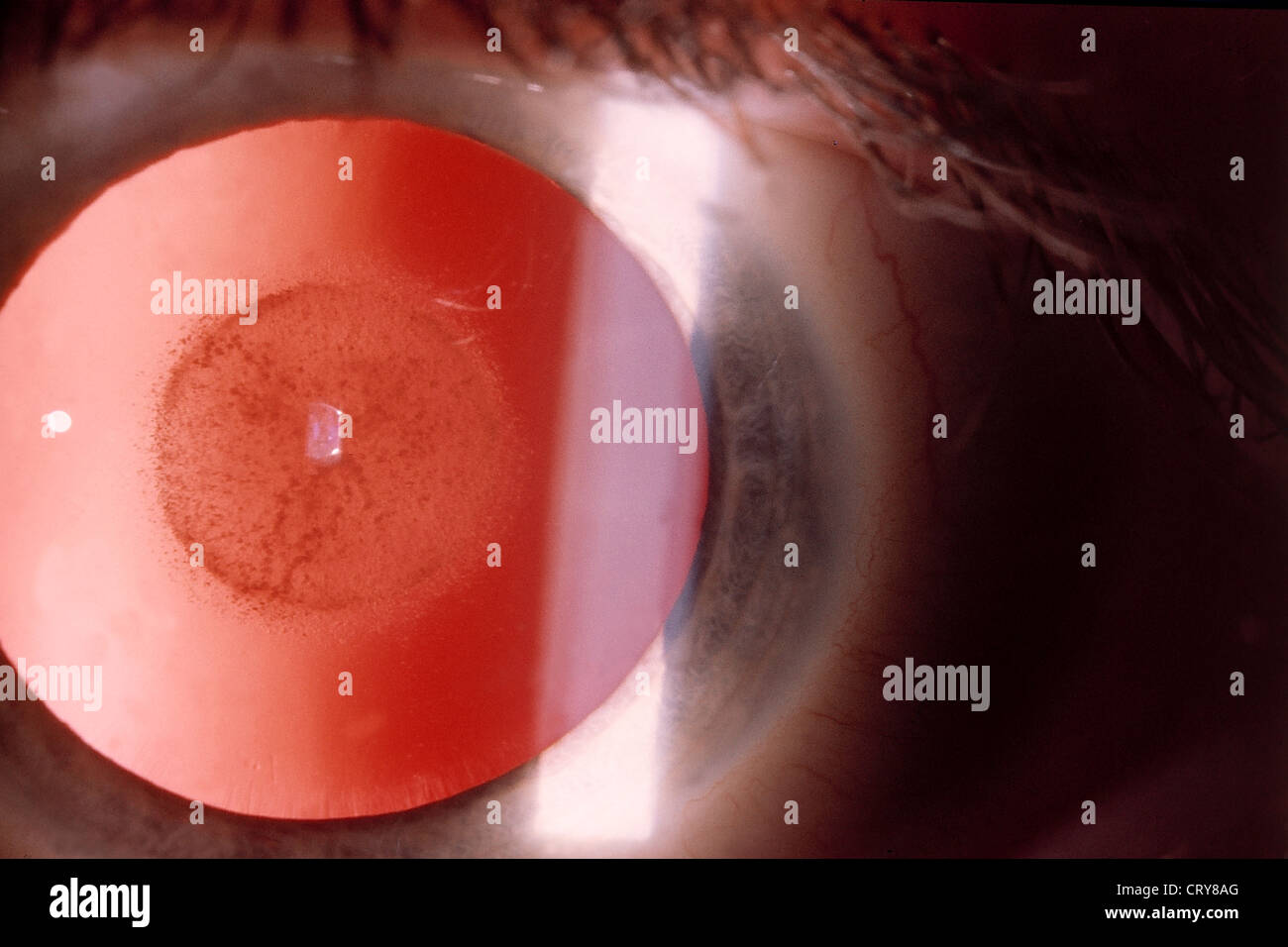 Nuclear cataract hi-res stock photography and images - Alamy