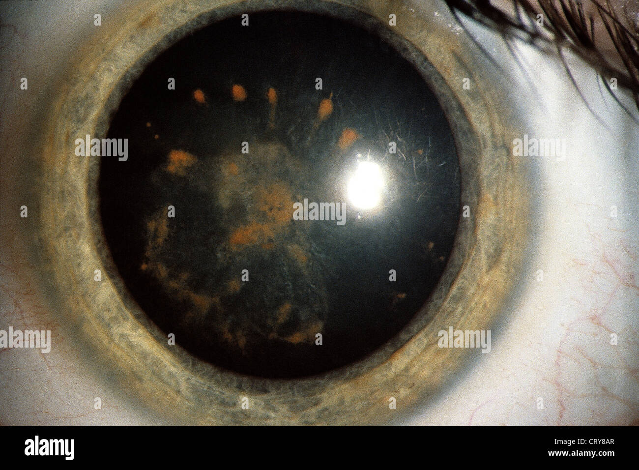 Ocular trauma hi-res stock photography and images - Alamy