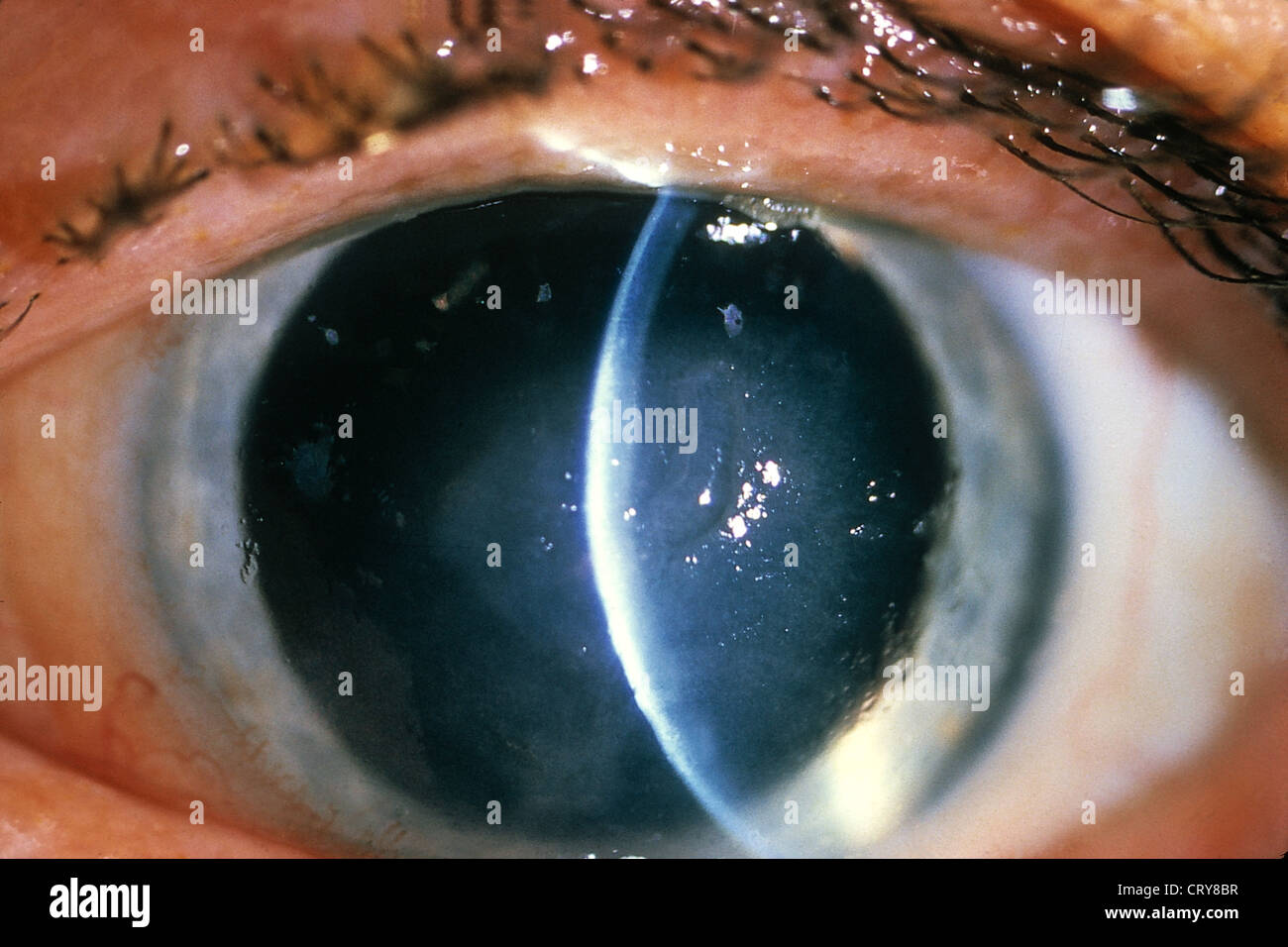 Keratitis hi-res stock photography and images - Alamy