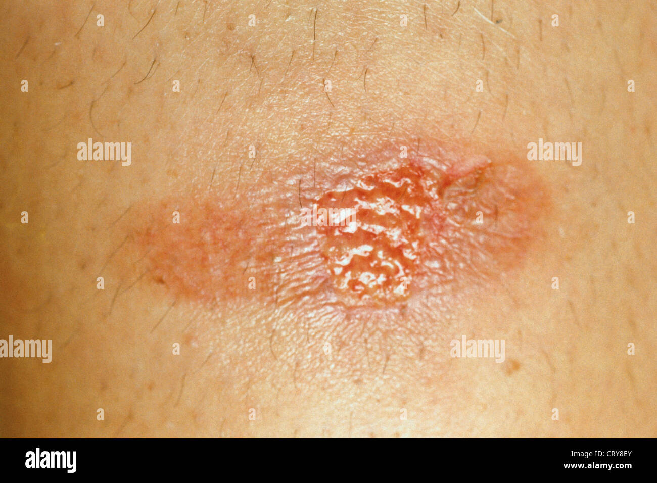 Burns and sores hi-res stock photography and images - Alamy