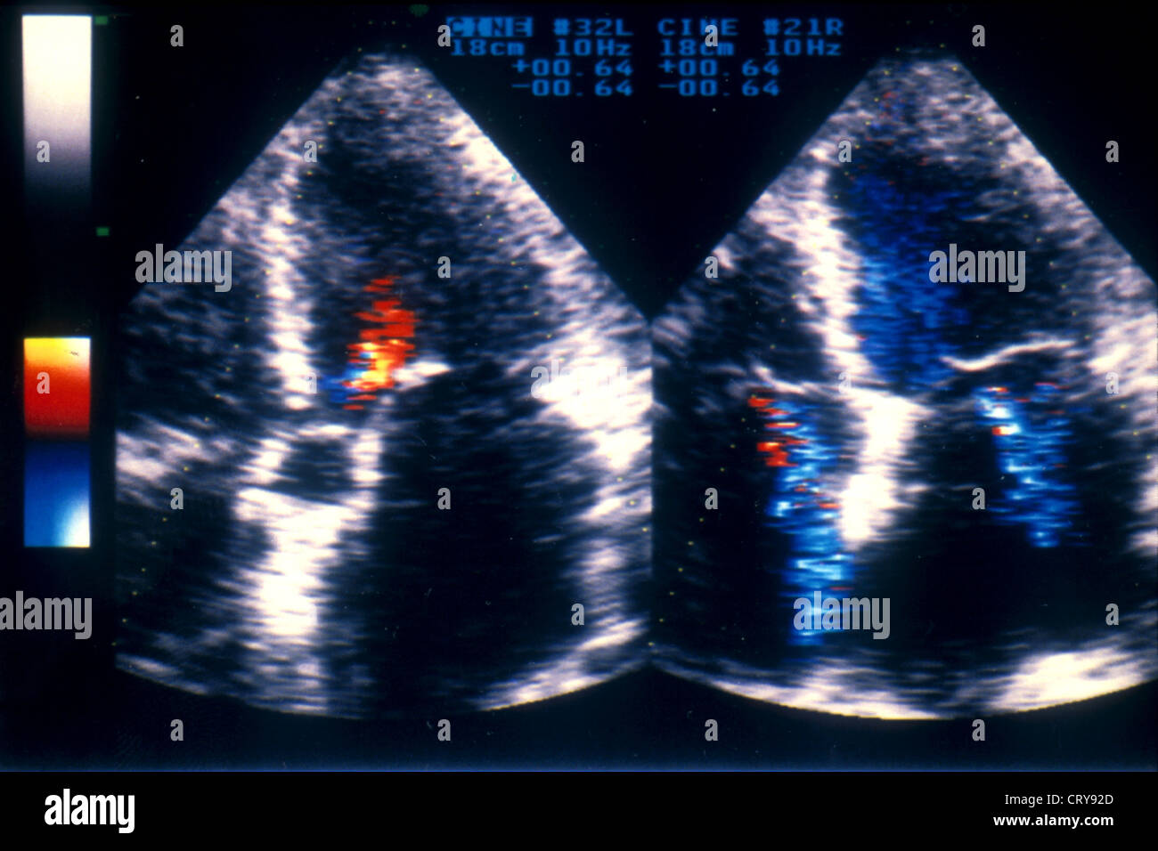 Heart failure scan hi-res stock photography and images - Alamy