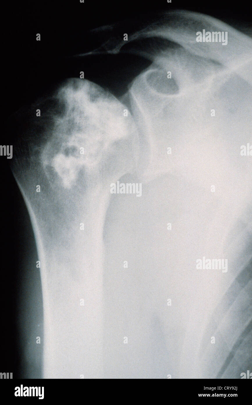 Shoulder joint x ray osteoarthritis hi-res stock photography and images ...