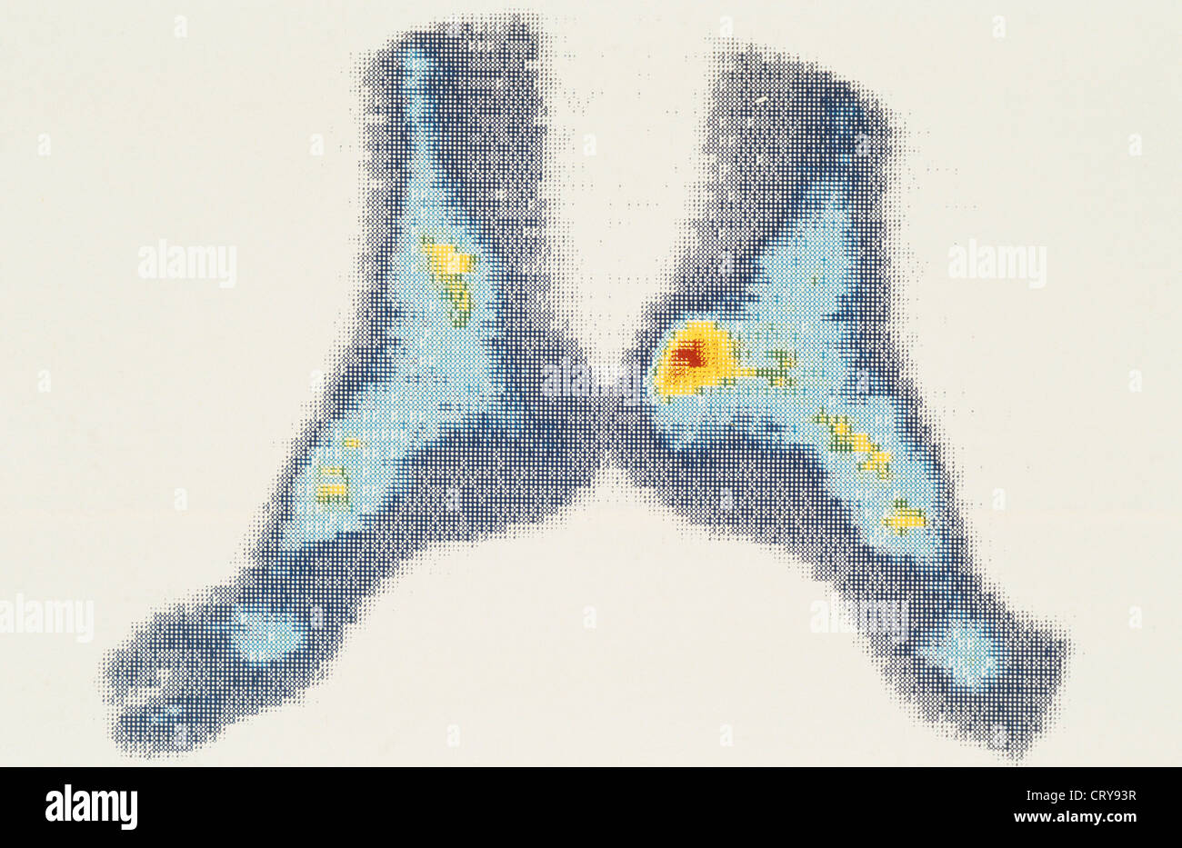 Periostitis hi-res stock photography and images - Alamy