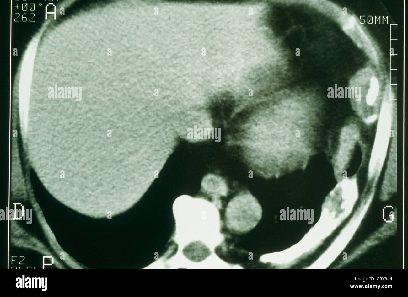 COLD ABSCESS, TUBERCULOSIS Stock Photo - Alamy