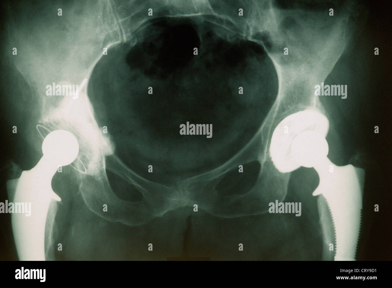 Hip replacements hi-res stock photography and images - Alamy