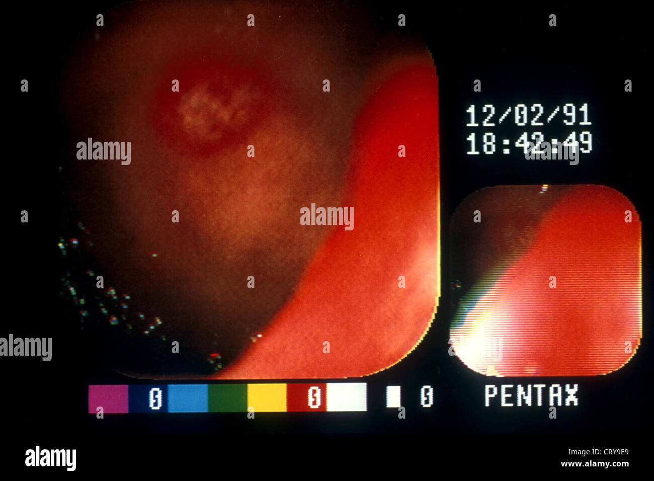 Endoscopy result hi-res stock photography and images - Alamy
