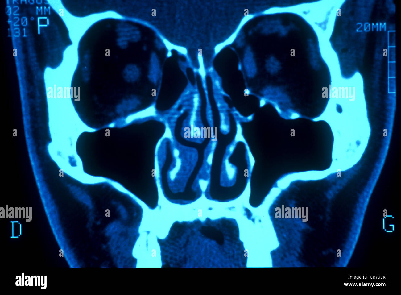 Sem cephalic heads sinus sinuses scientific hi-res stock photography ...
