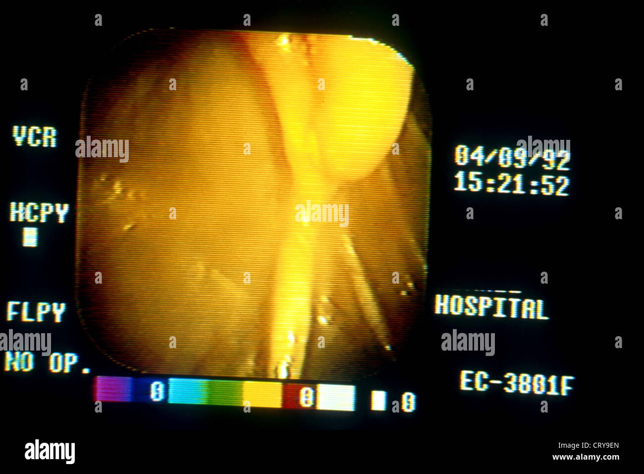 Fibroscopy hi-res stock photography and images - Alamy