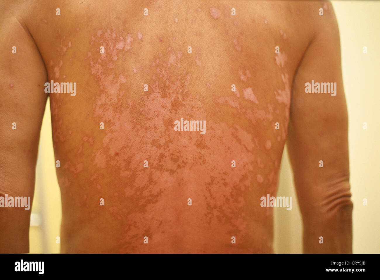 Psoriasis and back hi-res stock photography and images - Alamy