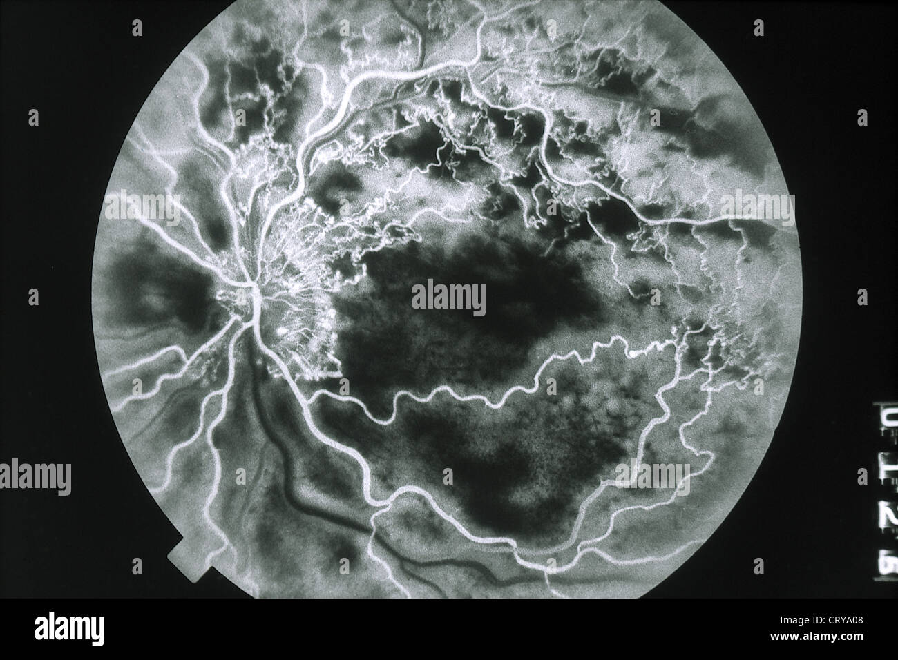 Angiography of the retina hi-res stock photography and images - Alamy