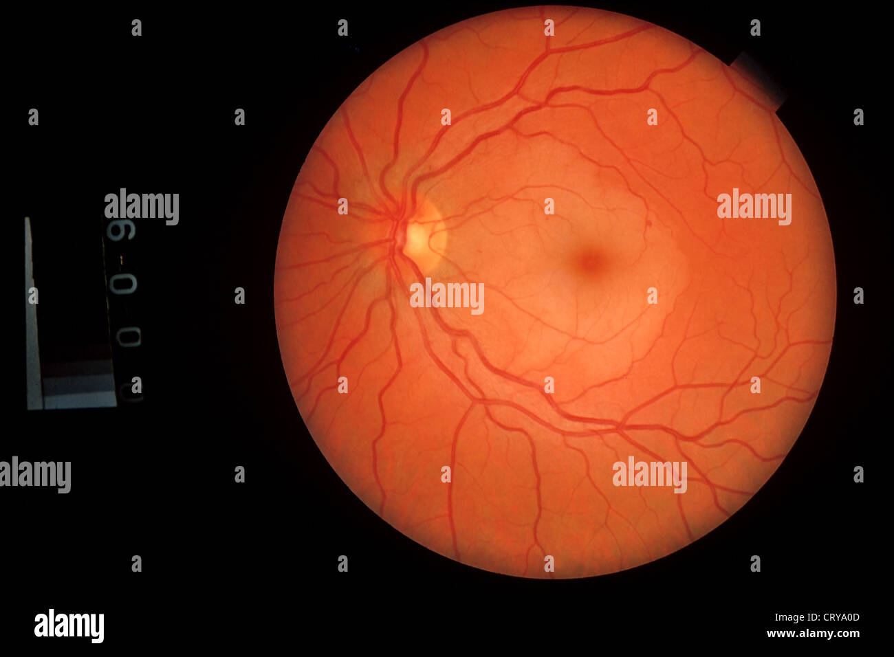Ophthalmic artery hi-res stock photography and images - Alamy