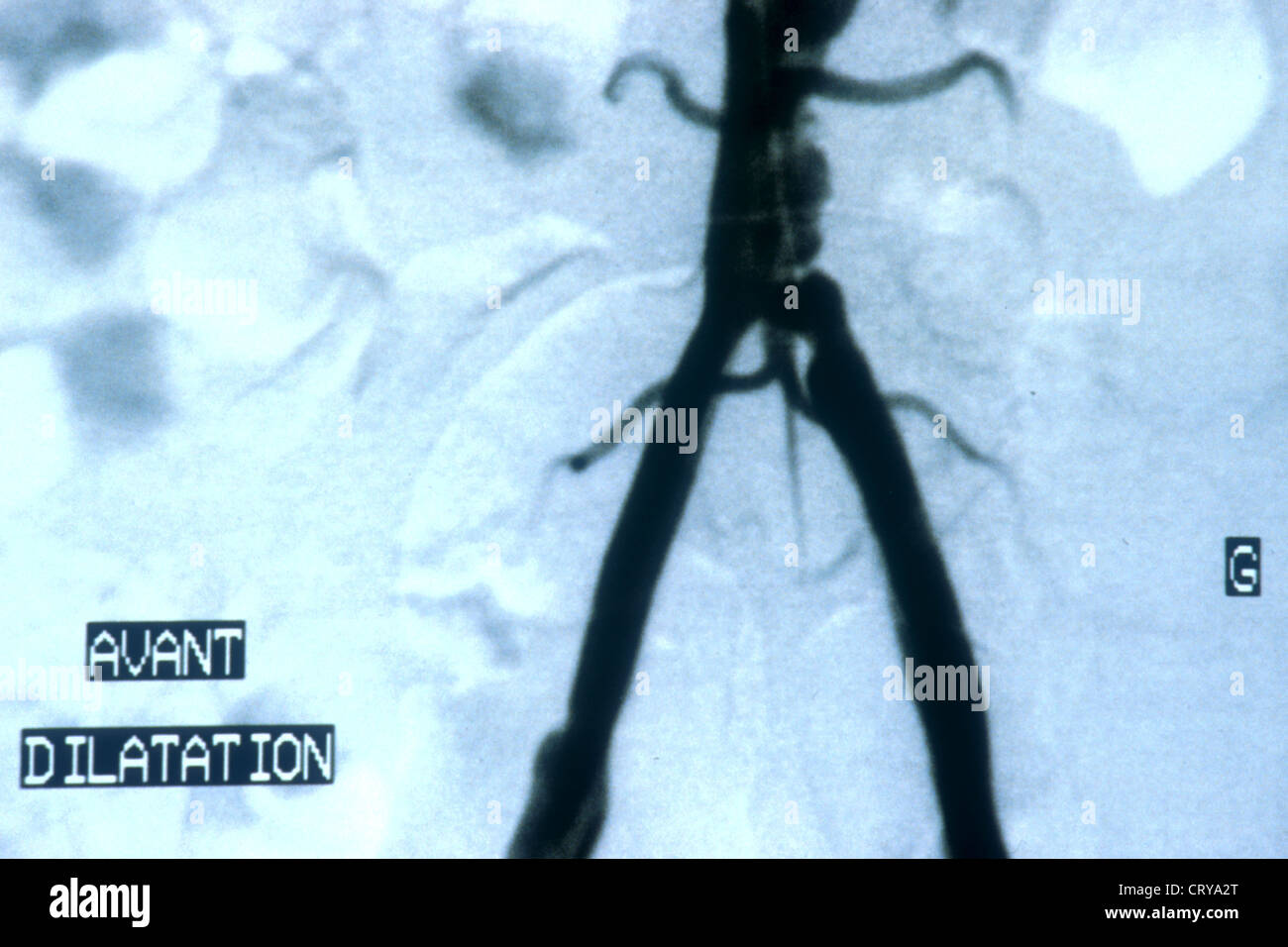 AORTIC STENOSIS, ANGIOGRAPHY Stock Photo - Alamy