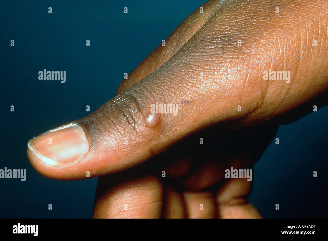Bullous skin disease hi-res stock photography and images - Alamy