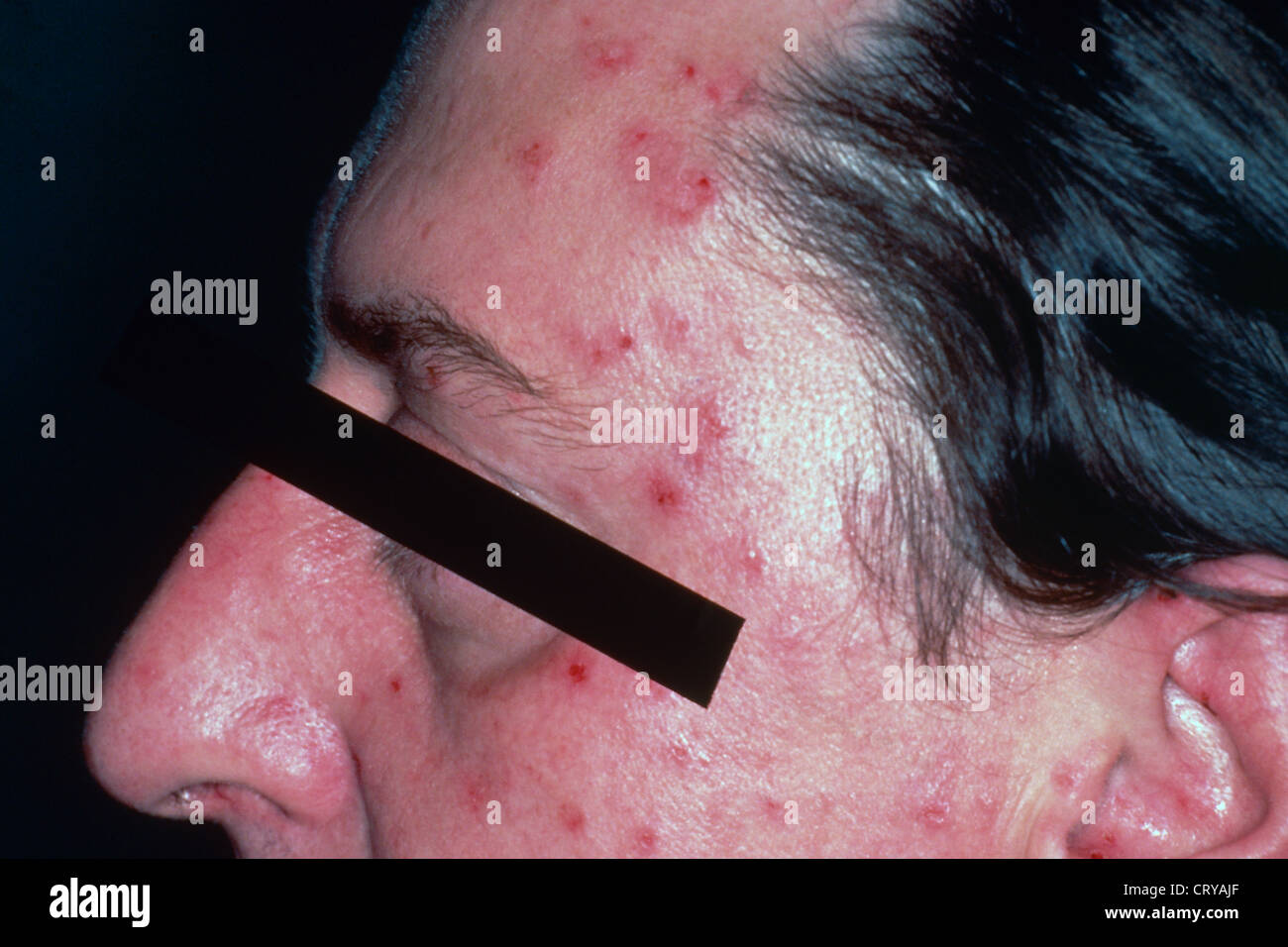 Prurigo hi-res stock photography and images - Alamy