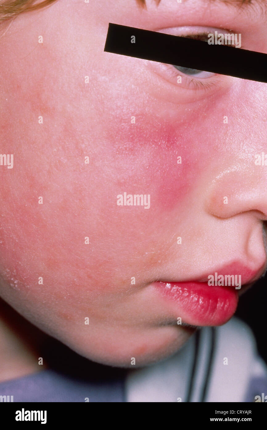 Atopic dermatitis face hi-res stock photography and images - Alamy