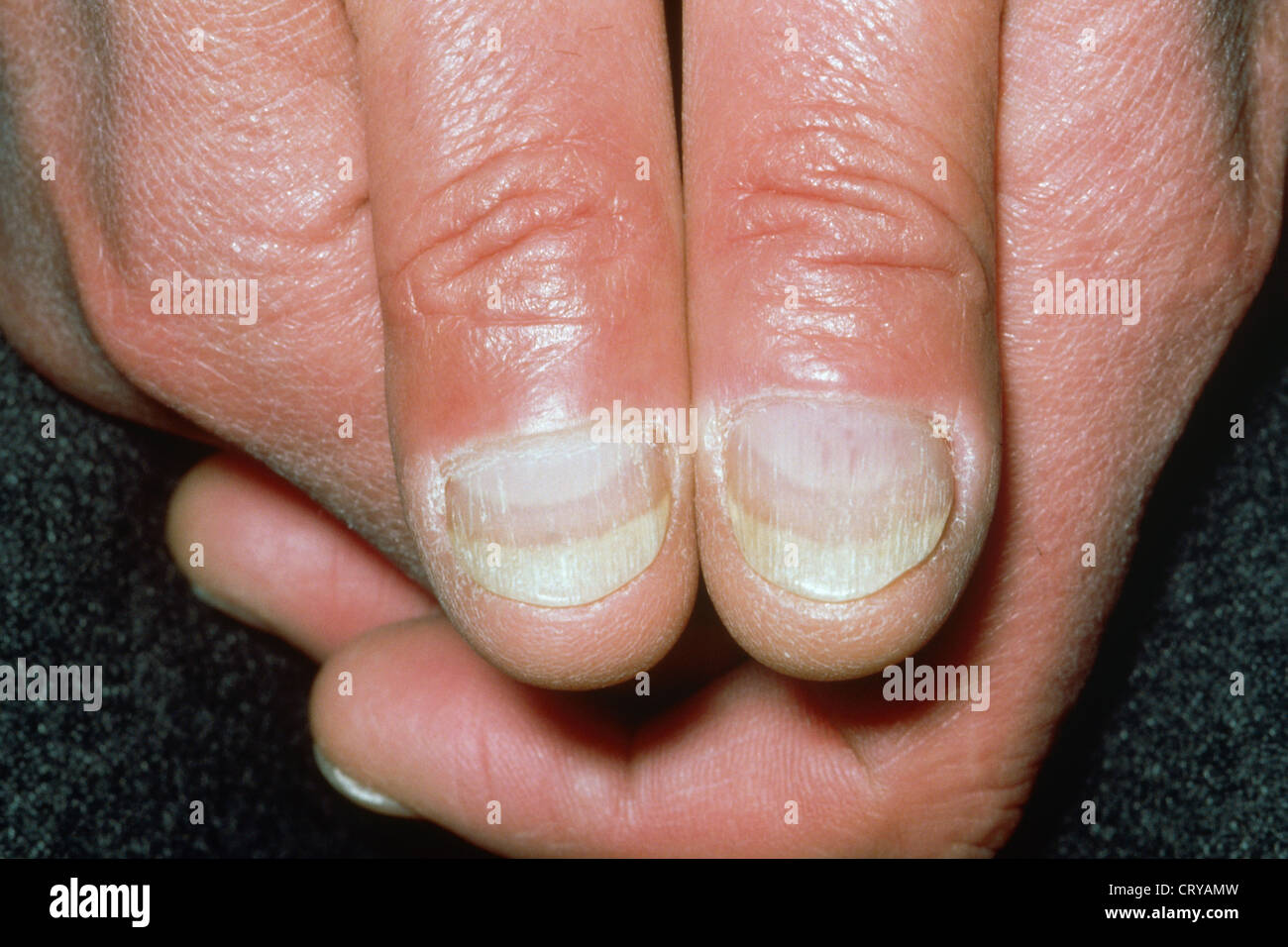 Psoriatic nail disease hi-res stock photography and images - Alamy