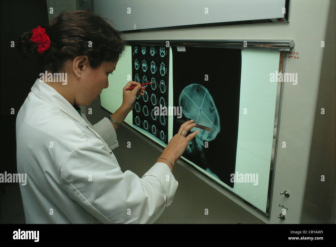 BRAIN CANCER RADIOTHERAPY Stock Photo - Alamy