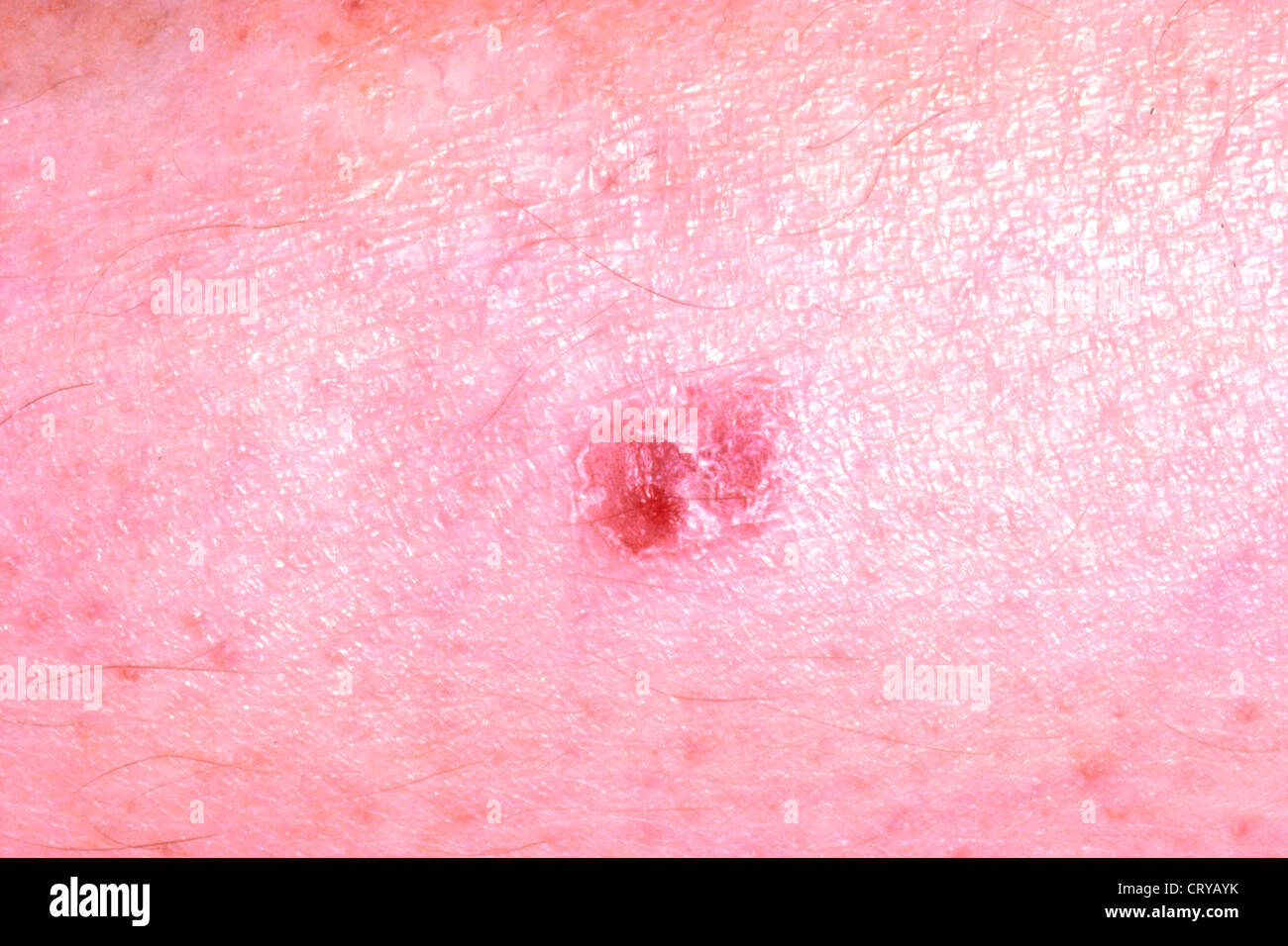 Bowens disease disease hi-res stock photography and images - Alamy