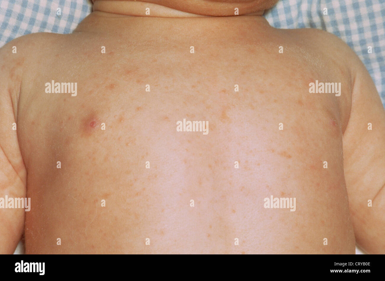 ACUTE HEMORRHAGIC EDEMA Stock Photo - Alamy