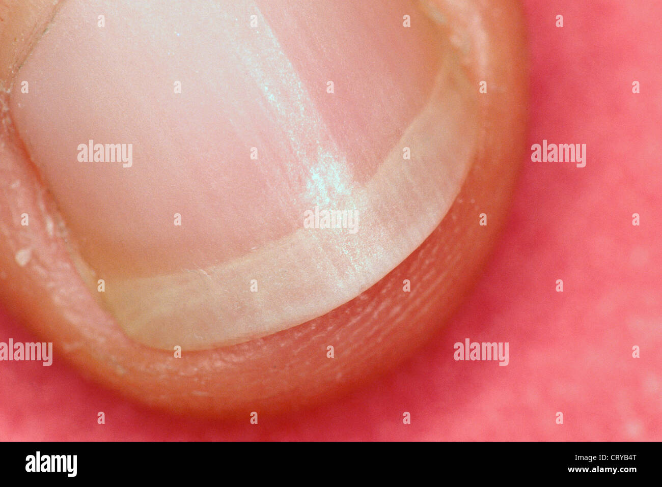 Leukonychia hi-res stock photography and images - Alamy