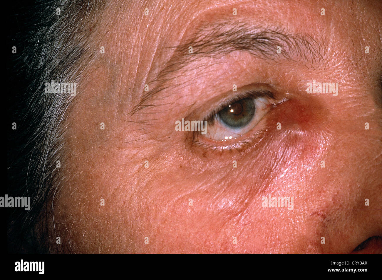 DACRYOCYSTITIS Stock Photo - Alamy