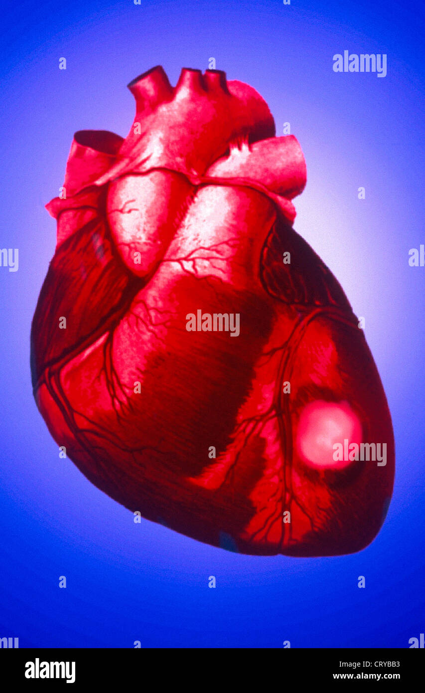 HEART ATTACK, DRAWING Stock Photo - Alamy