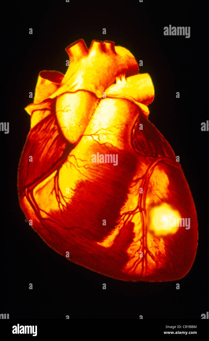 HEART ATTACK, DRAWING Stock Photo - Alamy