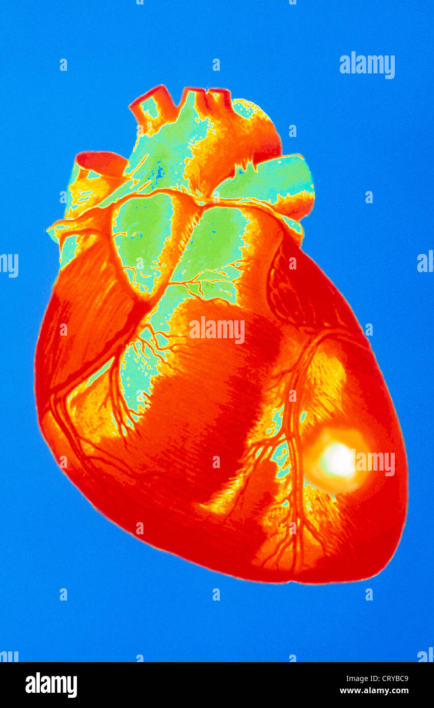 Heart Attack Drawing High Resolution Stock Photography and Images - Alamy