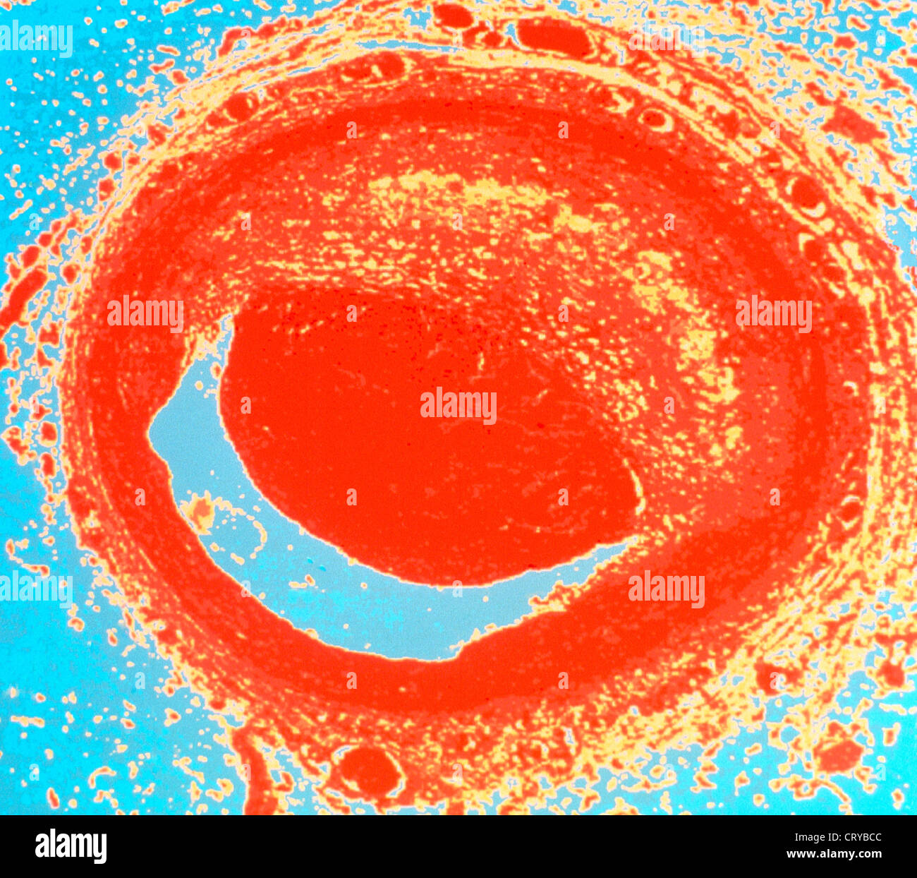 Atheroma micrograph hi-res stock photography and images - Alamy
