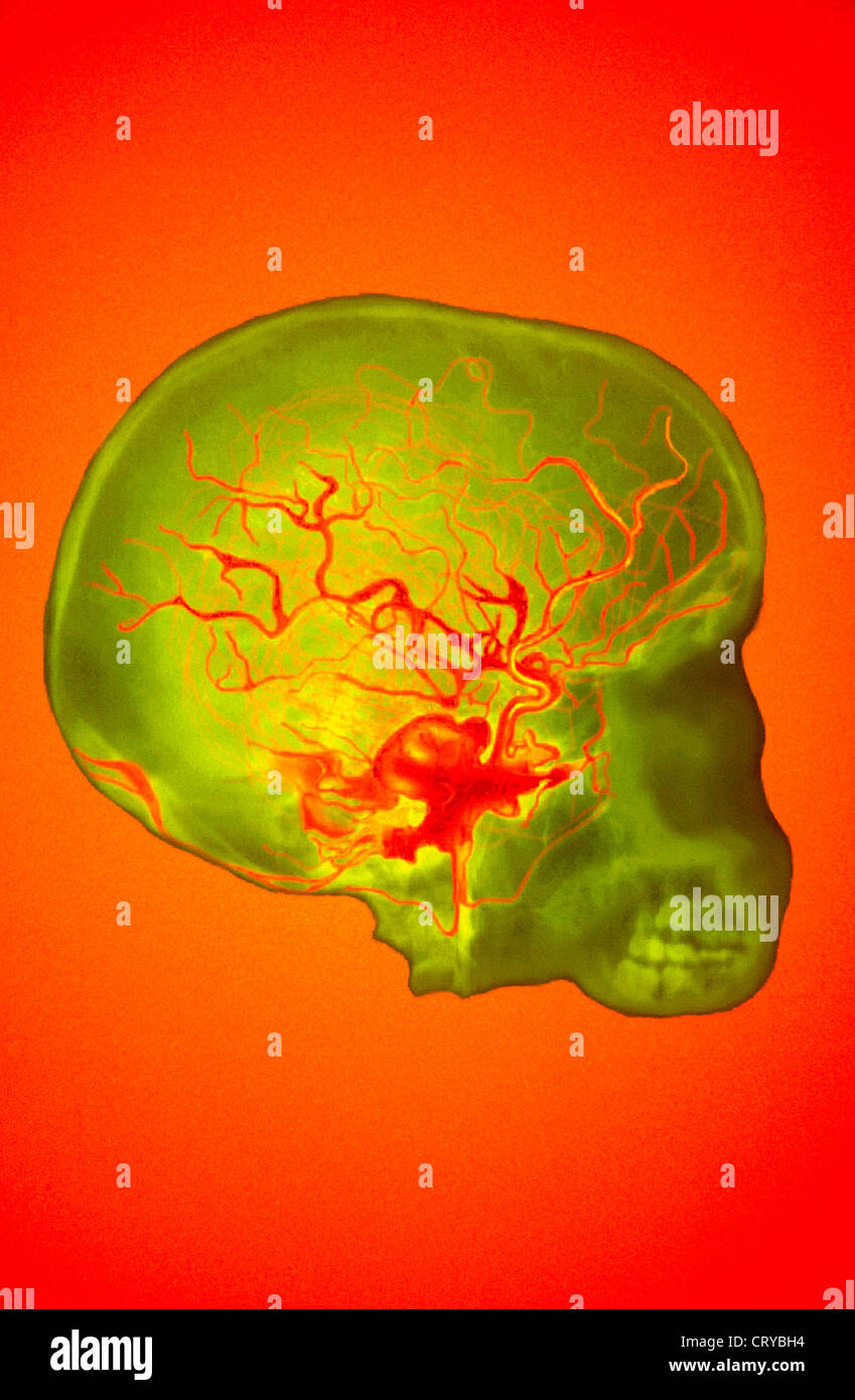Vascularisation cerebral hi-res stock photography and images - Alamy