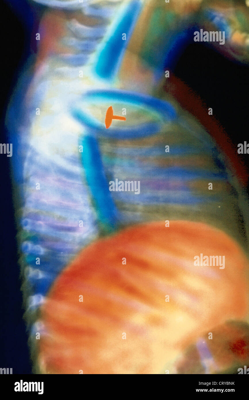 Foreign body x ray hi-res stock photography and images - Alamy