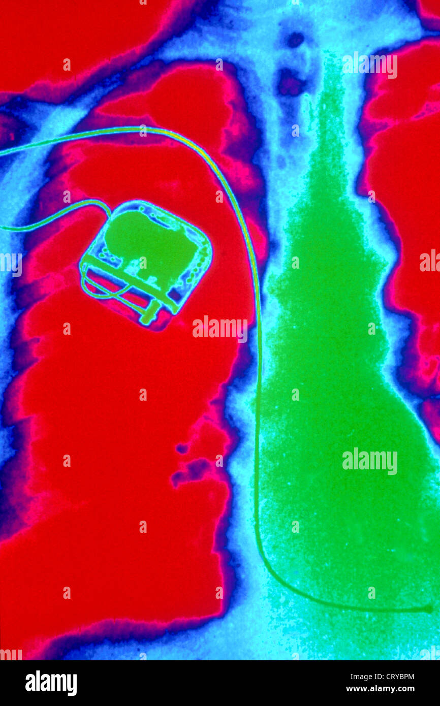 Heart pacemaker x ray hi-res stock photography and images - Alamy