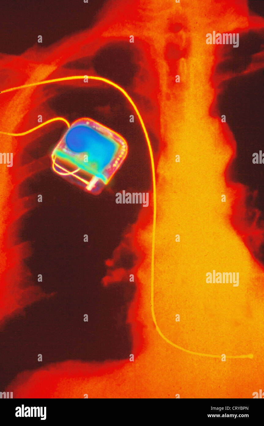 Heart pacemaker x ray hi-res stock photography and images - Alamy