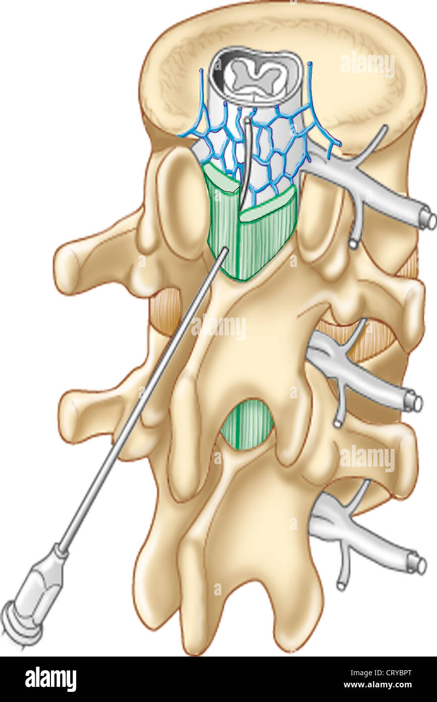 Epidural injections hi-res stock photography and images - Alamy